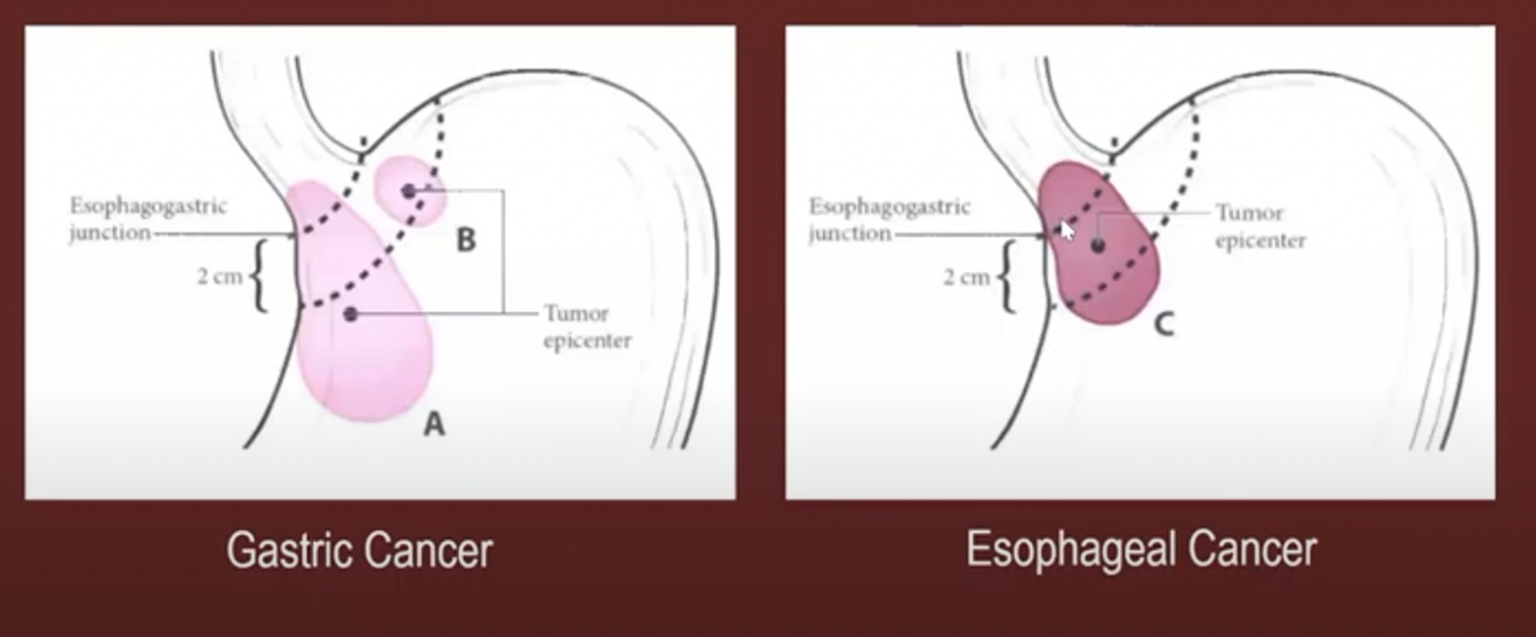 The current management of GE Junction Tumors