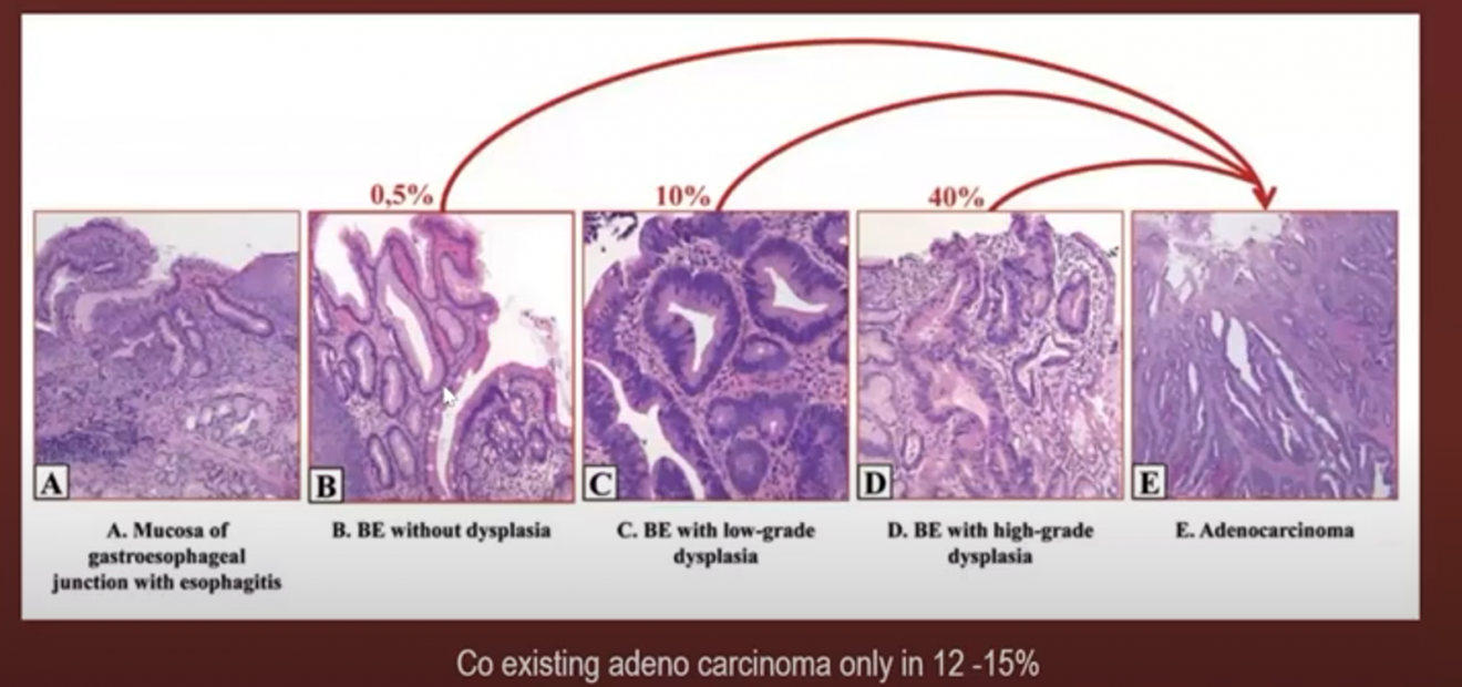The current management of GE Junction Tumors